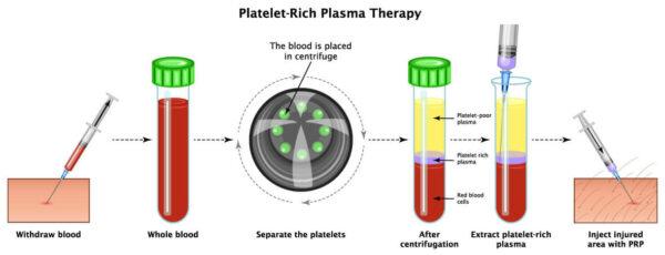 PRP vs. Stem Cell Exosome Treatments